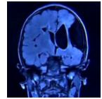 Surgical removal of half the brain – video – Mind Hacks