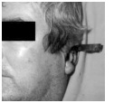 Neurosurgical removal of knife in head – Mind Hacks
