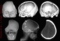 Patients with no skull are a window on brain activity – Mind Hacks